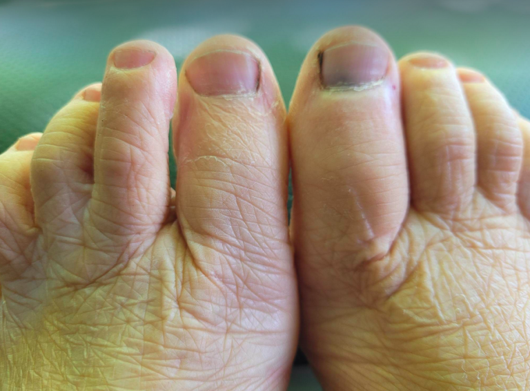 It happened to me - toe incident Nov 2022 - Heather Bruce Healing